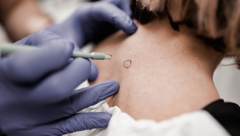 Skin Cancer Surgery Options | Excision & Post-Care | Shellharbour Skin